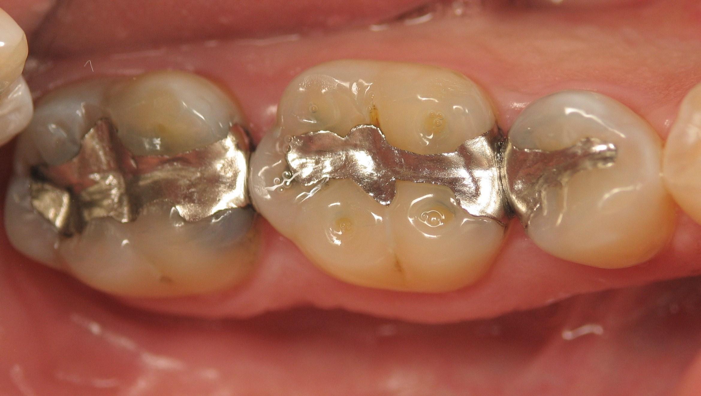 Estetske plombe za zube - Šta znači? | Dental SPA centar Niš