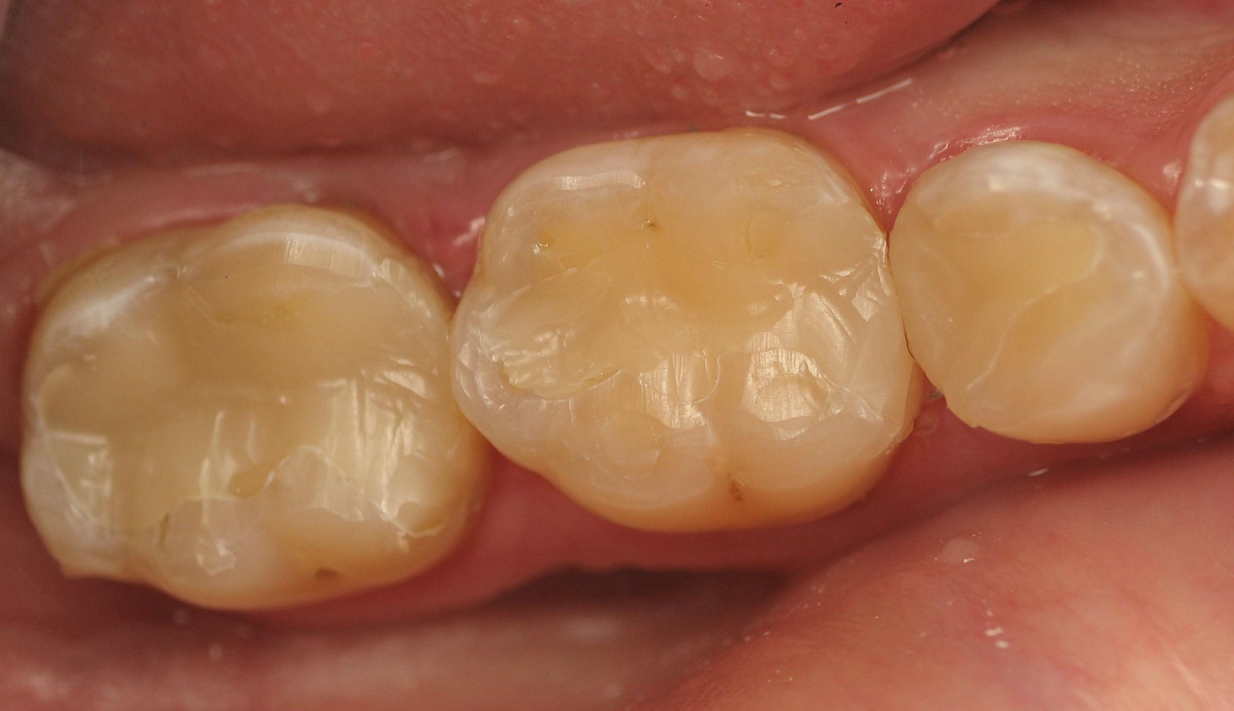 Estetske plombe za zube - Šta znači? | Dental SPA centar Niš