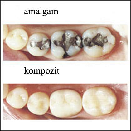 Estetske plombe za zube - Šta znači? | Dental SPA centar Niš